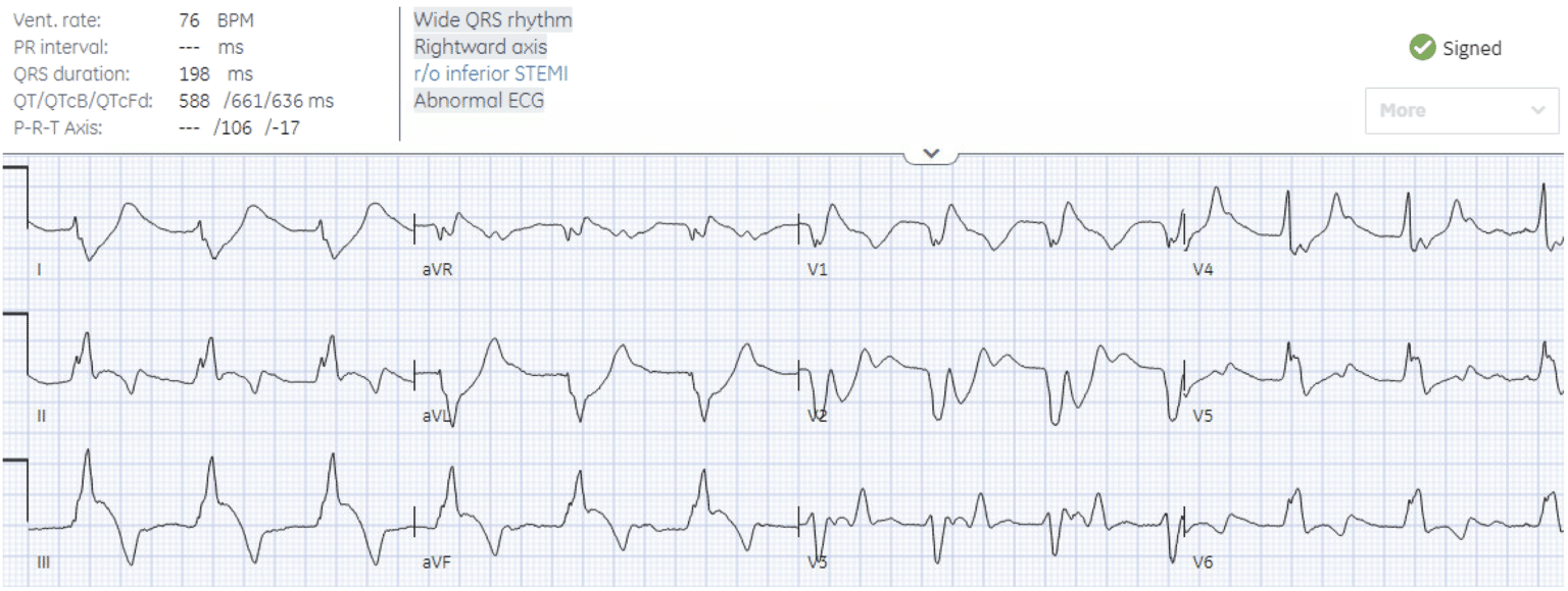 The Art of Occlusion MI, part 3: Impression | ECG Cases | Emergency ...