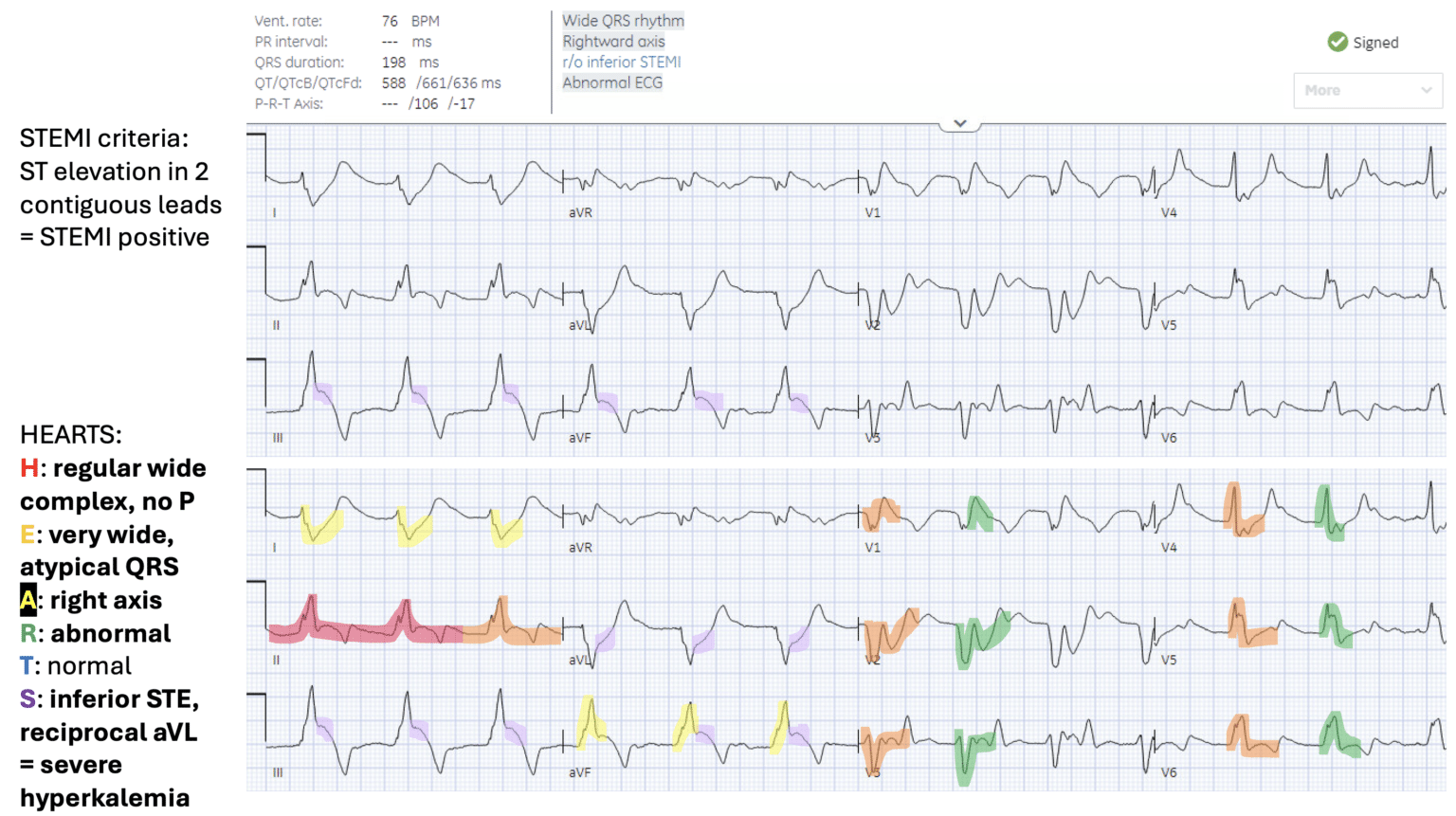 The Art of Occlusion MI, part 3: Impression | ECG Cases | Emergency ...