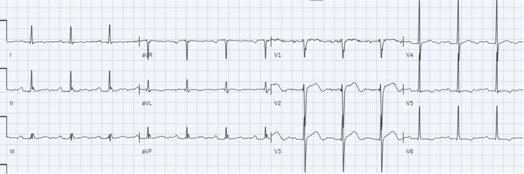 The Art of Occlusion MI, part 3: Impression | ECG Cases | Emergency ...