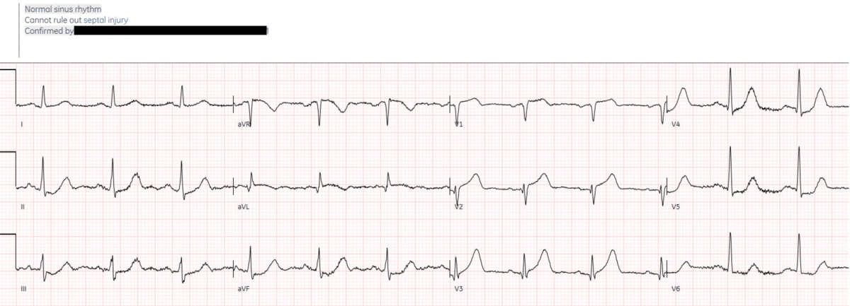 The Art of Occlusion MI, part 3: Impression | ECG Cases | Emergency ...