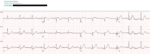 The Art of Occlusion MI, part 3: Impression | ECG Cases | Emergency ...