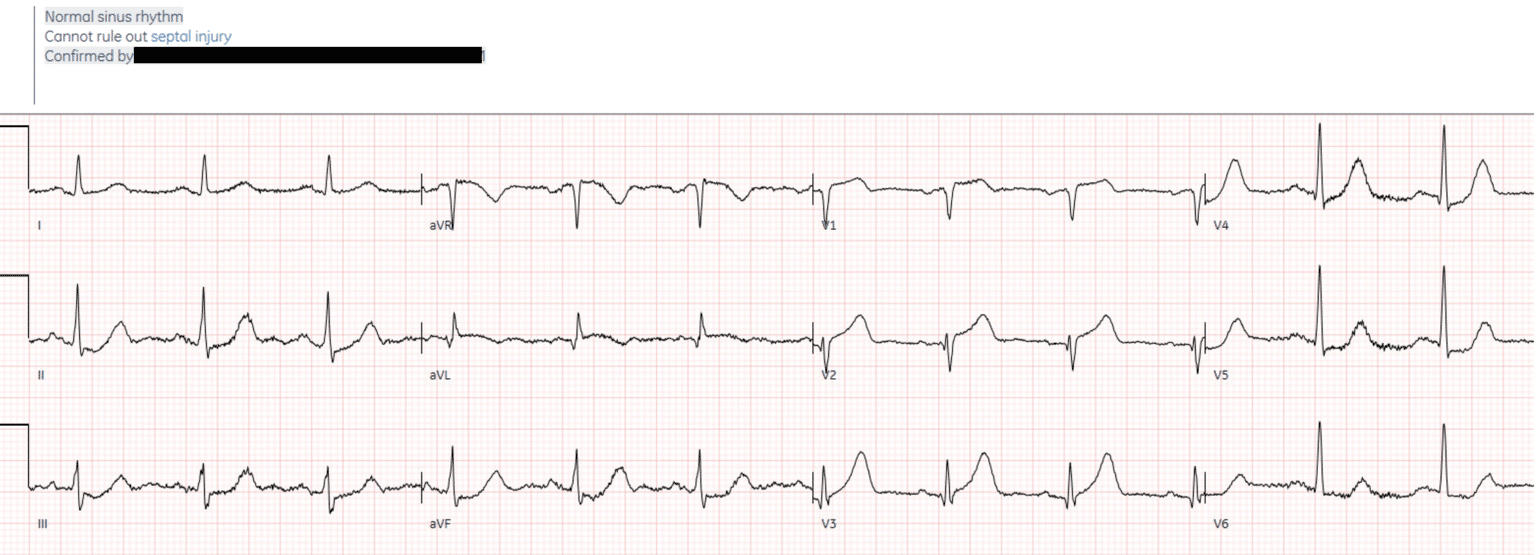 The Art of Occlusion MI, part 3: Impression | ECG Cases | Emergency ...