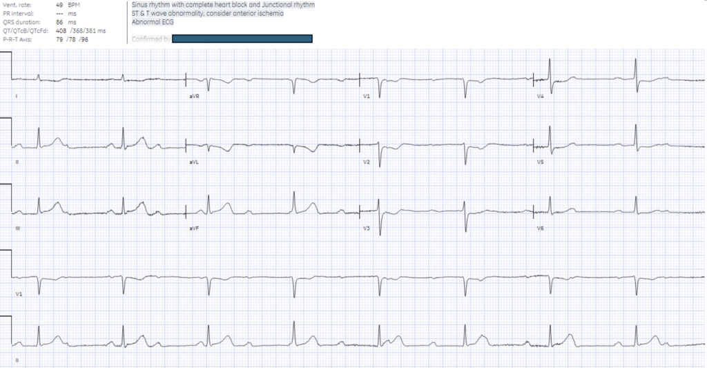Art of Occlusion MI Part 4: Sequence Photos | ECG Cases | Emergency ...