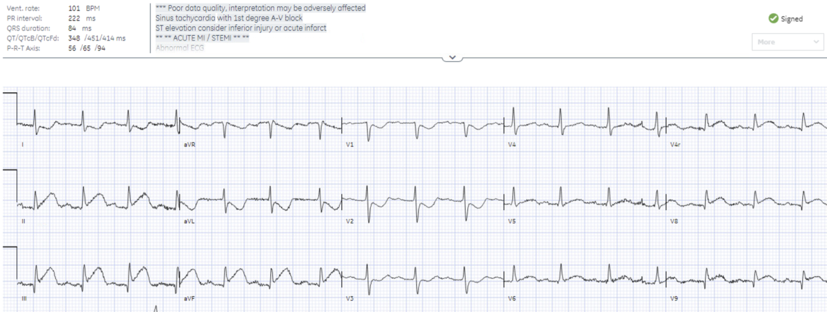 Art of Occlusion MI Part 4: Sequence Photos | ECG Cases | Emergency ...