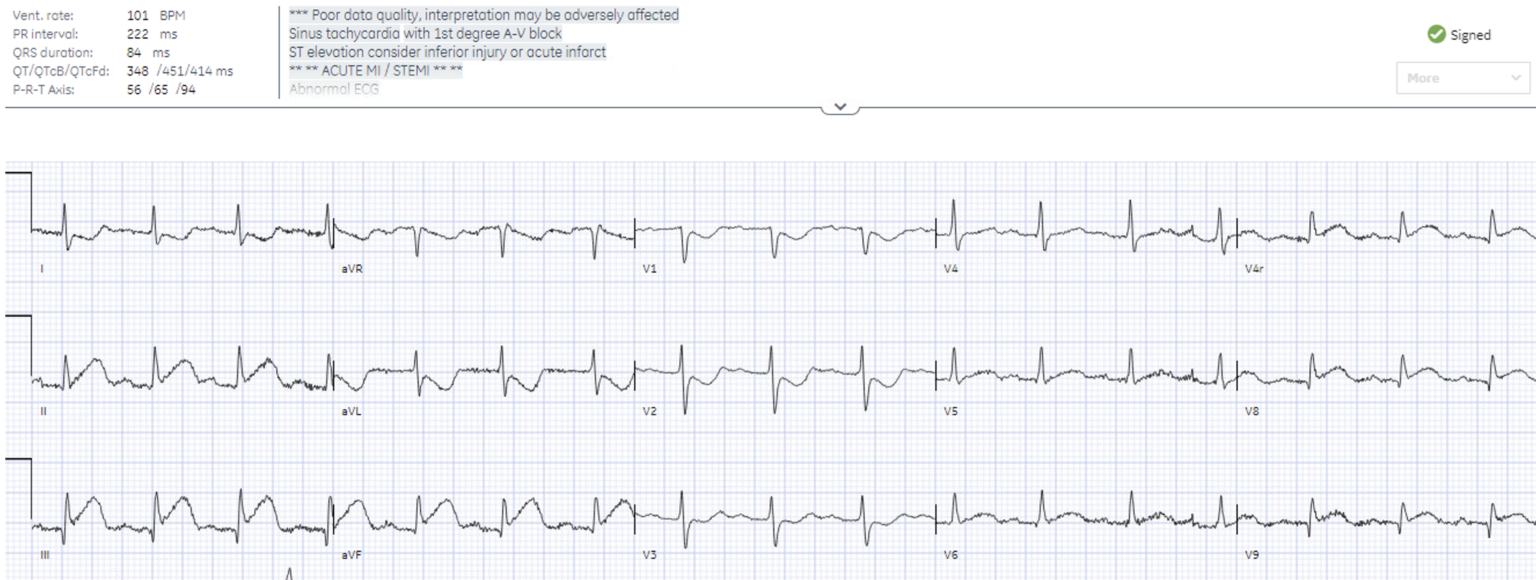 Art of Occlusion MI Part 4: Sequence Photos | ECG Cases | Emergency ...