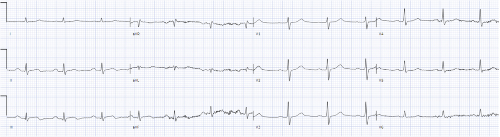 Art of Occlusion MI Part 4: Sequence Photos | ECG Cases | Emergency Medicine Cases
