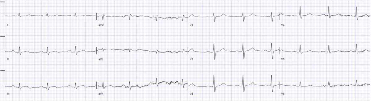 Art of Occlusion MI Part 4: Sequence Photos | ECG Cases | Emergency ...