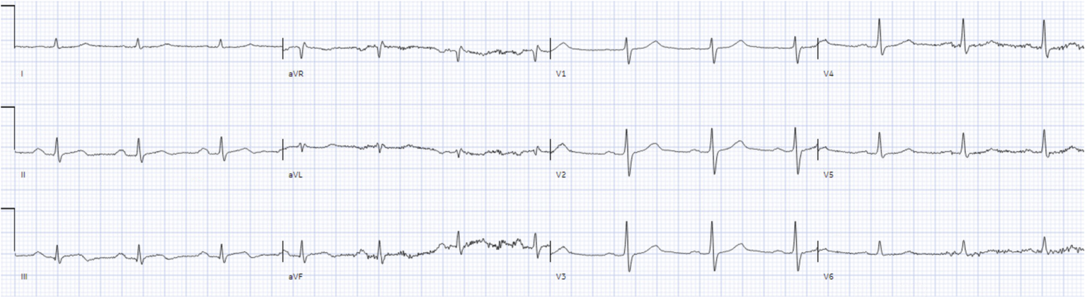 Art of Occlusion MI Part 4: Sequence Photos | ECG Cases | Emergency ...