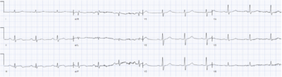 Art of Occlusion MI Part 4: Sequence Photos | ECG Cases | Emergency ...