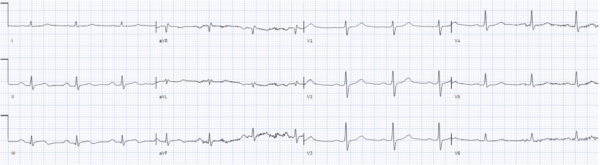 Art of Occlusion MI Part 4: Sequence Photos | ECG Cases | Emergency ...