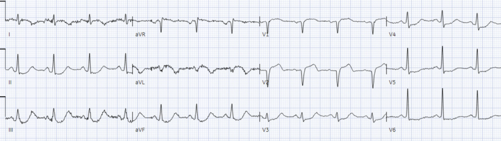 Art of Occlusion MI Part 4: Sequence Photos | ECG Cases | Emergency ...