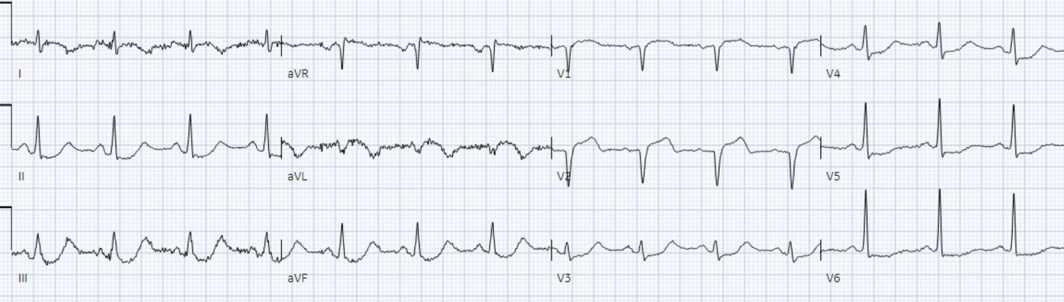 Art of Occlusion MI Part 4: Sequence Photos | ECG Cases | Emergency ...
