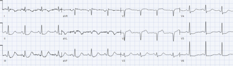 Art of Occlusion MI Part 4: Sequence Photos | ECG Cases | Emergency ...