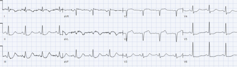 Art of Occlusion MI Part 4: Sequence Photos | ECG Cases | Emergency ...