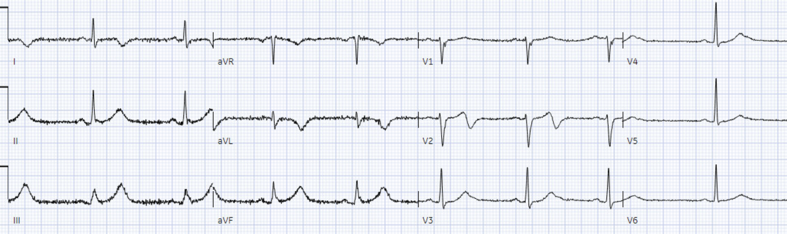 Art of Occlusion MI Part 4: Sequence Photos | ECG Cases | Emergency ...