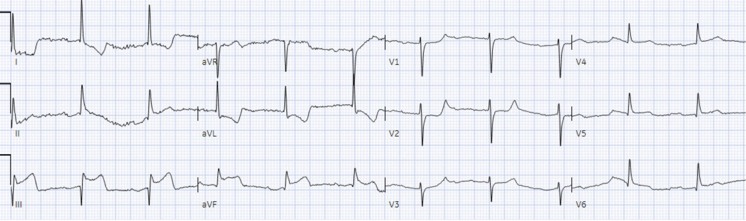 Art of Occlusion MI Part 4: Sequence Photos | ECG Cases | Emergency ...