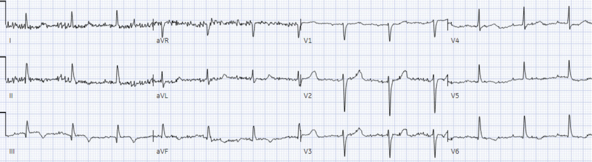 Art of Occlusion MI Part 4: Sequence Photos | ECG Cases | Emergency ...