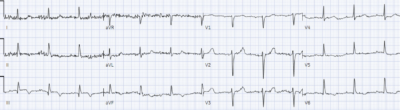 Art of Occlusion MI Part 4: Sequence Photos | ECG Cases | Emergency ...