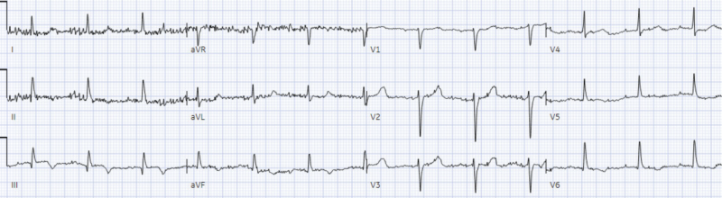 Art of Occlusion MI Part 4: Sequence Photos | ECG Cases | Emergency ...