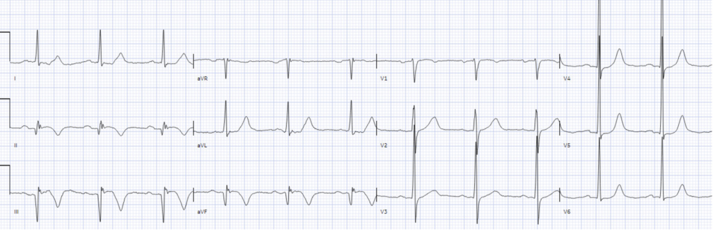 Art of Occlusion MI Part 4: Sequence Photos | ECG Cases | Emergency ...