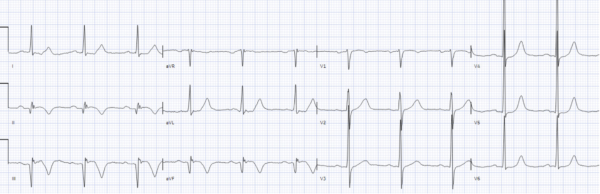 Art of Occlusion MI Part 4: Sequence Photos | ECG Cases | Emergency ...