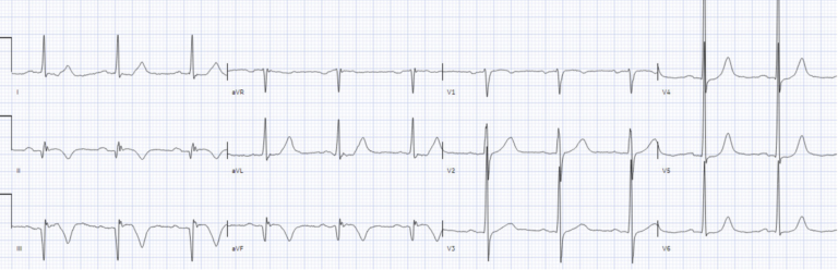 Art of Occlusion MI Part 4: Sequence Photos | ECG Cases | Emergency ...