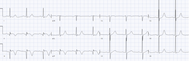 Art of Occlusion MI Part 4: Sequence Photos | ECG Cases | Emergency ...