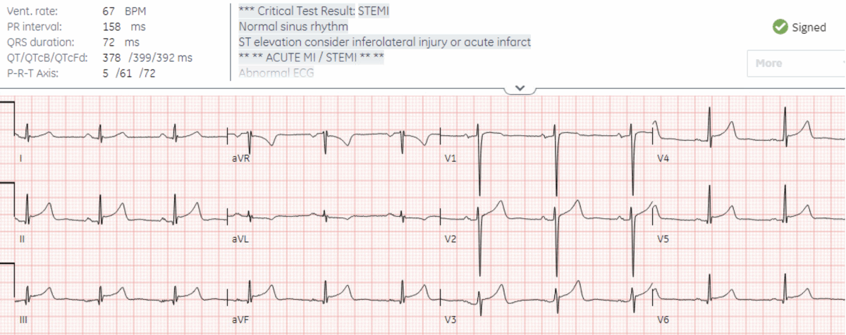 Case 2 : 40 year old with three days of pleuritic chest pain. Normal POCUS