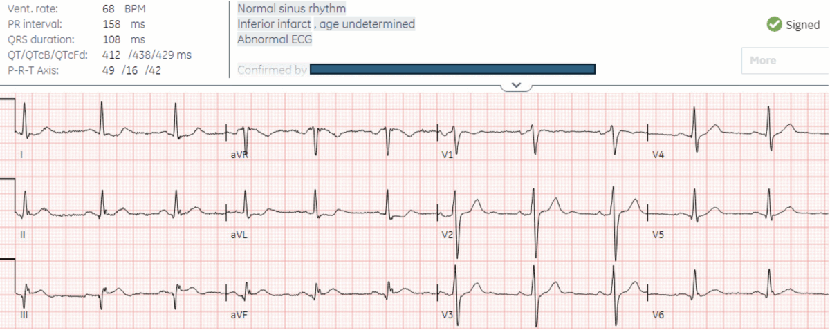 Heart rate/rhythm: normal Electrical conduction: normal Axis: normal R ...