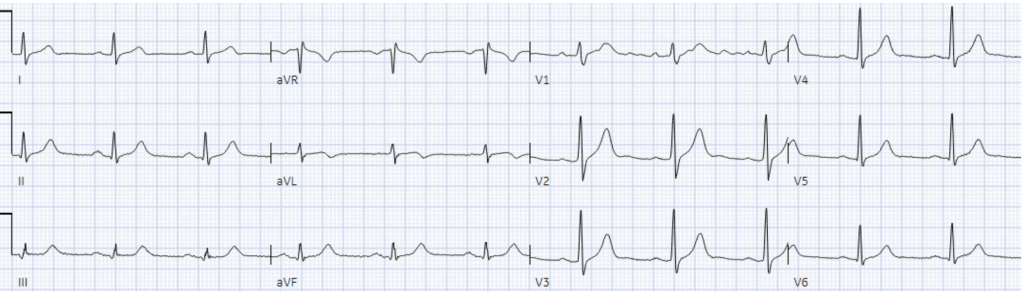 Art of Occlusion MI: Clinical-ECG-POCUS Triptych | ECG Cases ...