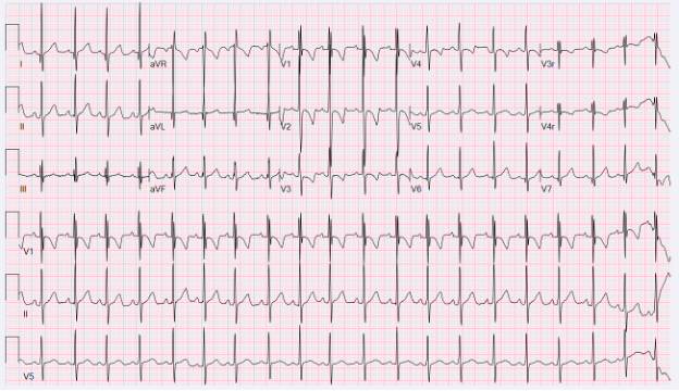 Tick Borne Illness Update, Pediatric ECG Interpretation, Nailbed Repair ...