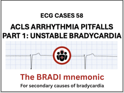 ACLS Dysrhythmia Pitfalls: Unstable Bradycardia | ECG Cases | EM Cases