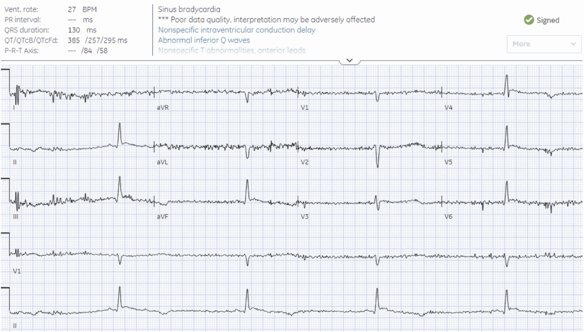 ACLS Dysrhythmia Pitfalls: Unstable Bradycardia | ECG Cases | EM Cases