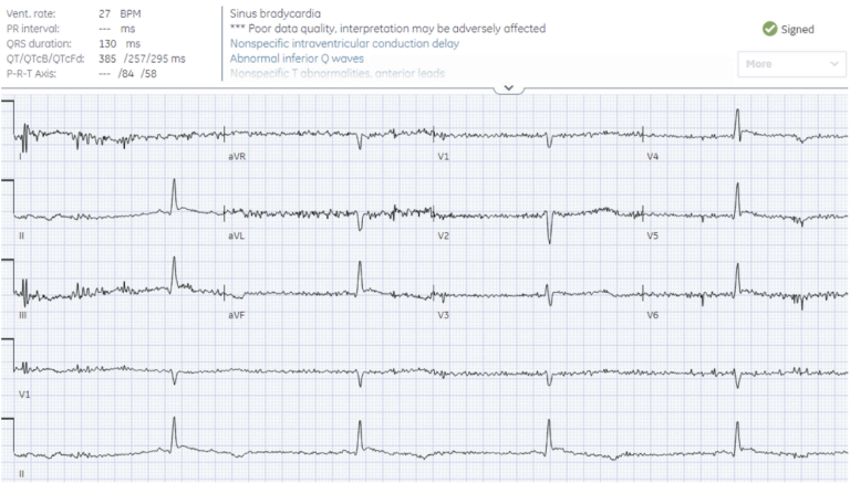 ACLS Dysrhythmia Pitfalls: Unstable Bradycardia | ECG Cases | EM Cases