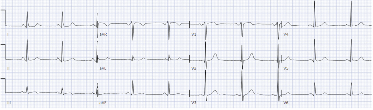 ACLS Dysrhythmia Pitfalls: Unstable Bradycardia | ECG Cases | EM Cases