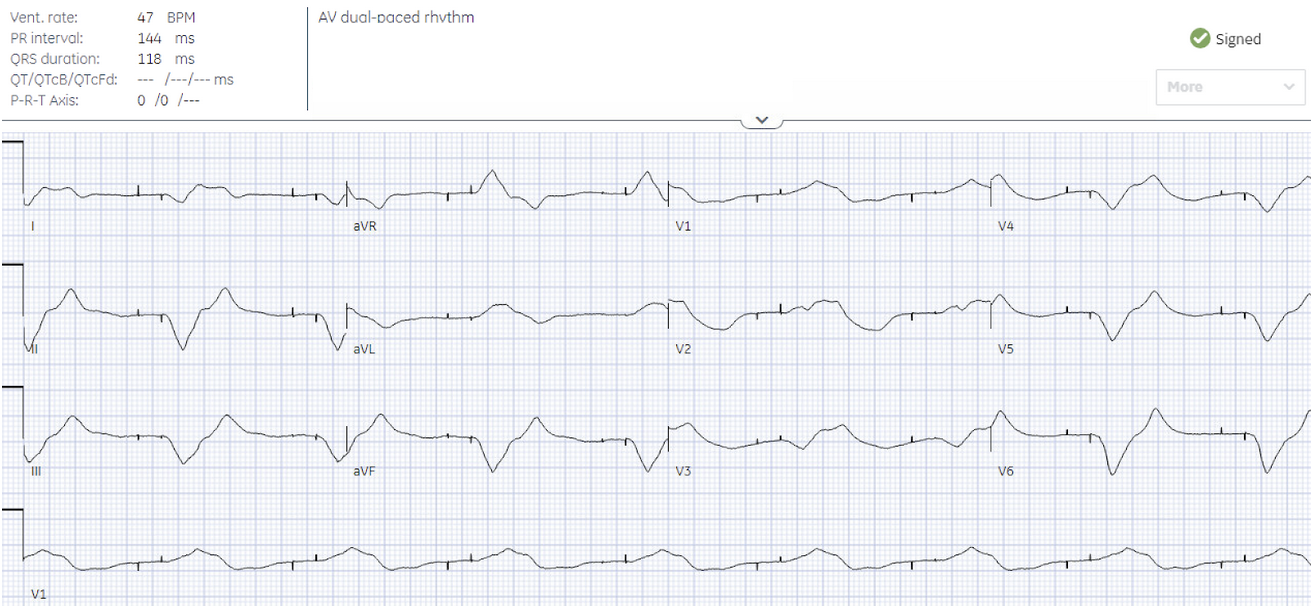 ACLS Dysrhythmia Pitfalls: Unstable Bradycardia | ECG Cases | EM Cases