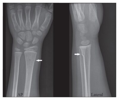 Osteomyelitis, Tourniquet Technique, Pediatric Distal Radius Buckle ...