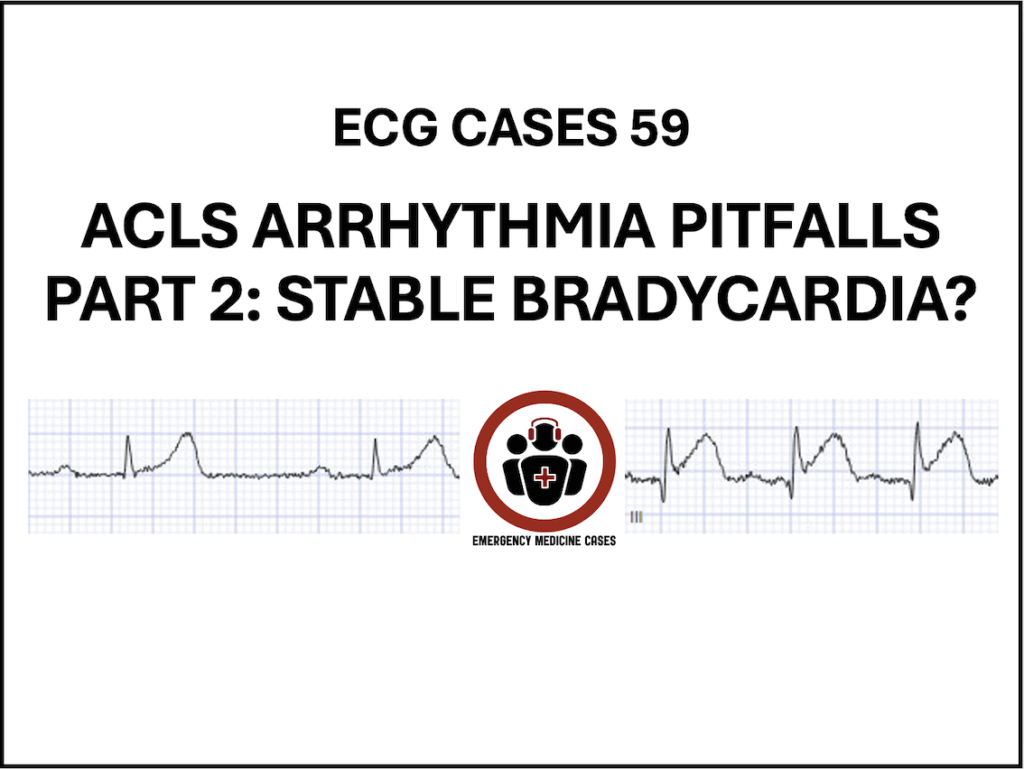 ECG Cases blog | Emergency Medicine Cases