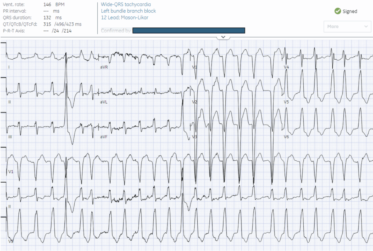 Unstable tachycardia, cardiovert? | ECG Cases | Emergency Medicine Cases