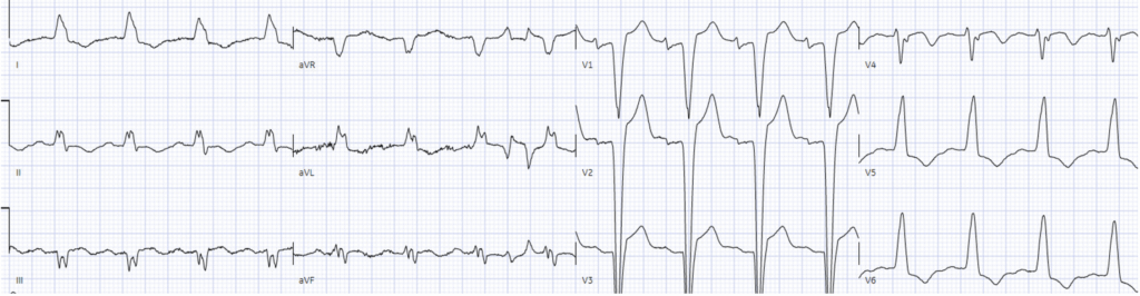 Unstable tachycardia, cardiovert? | ECG Cases | Emergency Medicine Cases