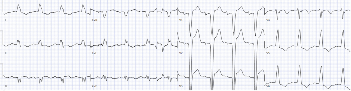 Unstable tachycardia, cardiovert? | ECG Cases | Emergency Medicine Cases