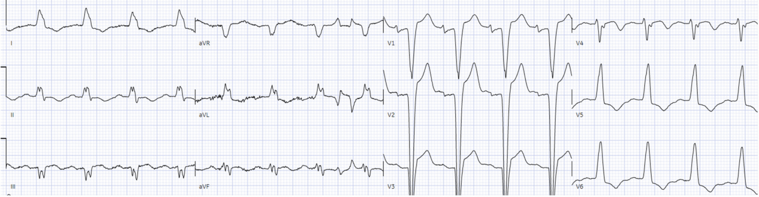 Unstable tachycardia, cardiovert? | ECG Cases | Emergency Medicine Cases
