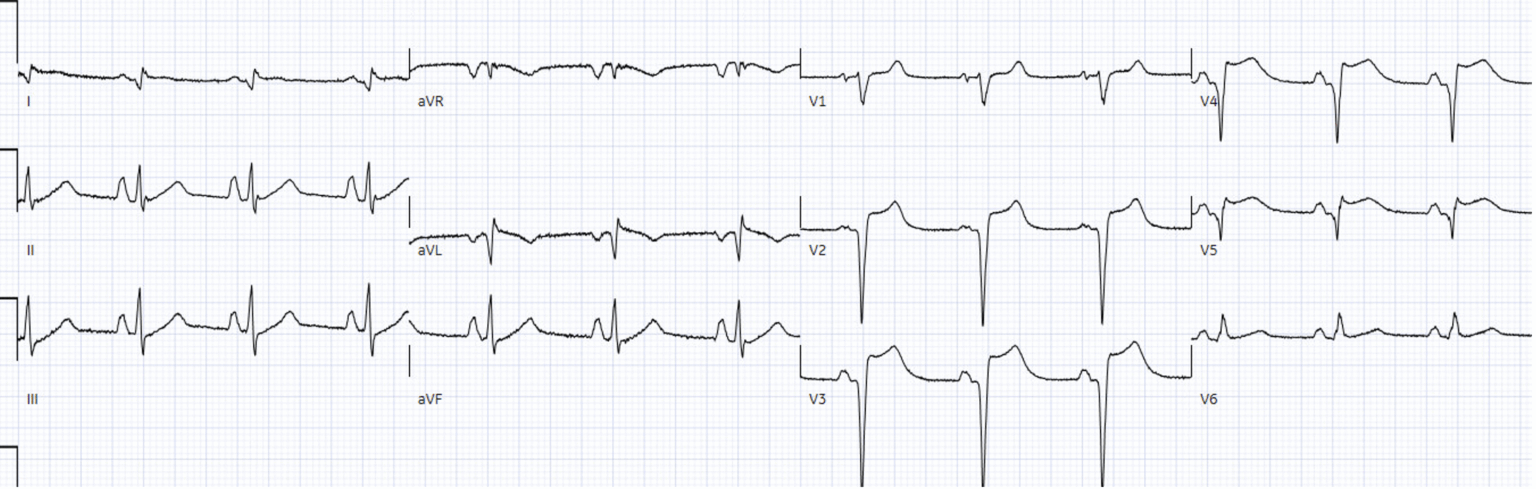 Unstable tachycardia, cardiovert? | ECG Cases | Emergency Medicine Cases