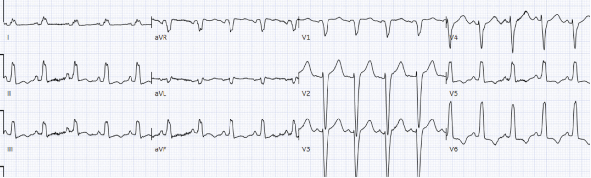 Unstable tachycardia, cardiovert? | ECG Cases | Emergency Medicine Cases