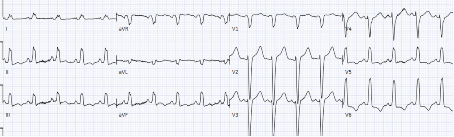 Unstable tachycardia, cardiovert? | ECG Cases | Emergency Medicine Cases