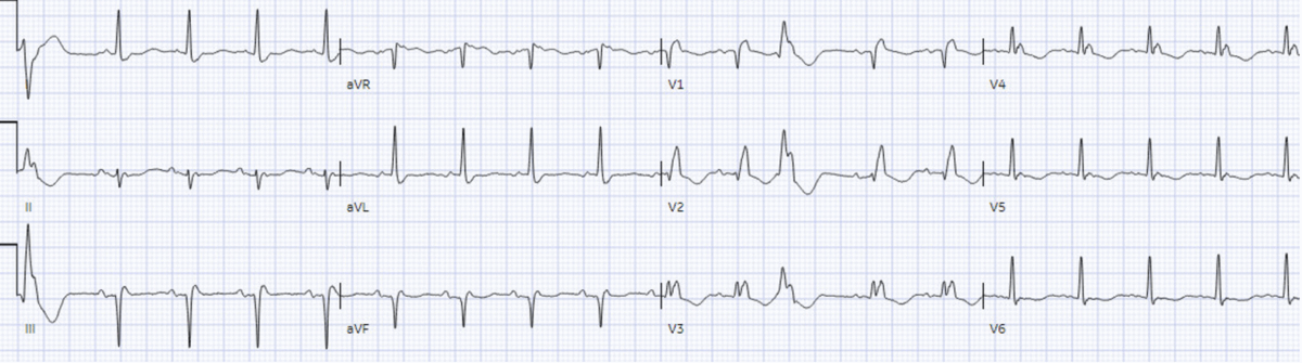 Unstable tachycardia, cardiovert? | ECG Cases | Emergency Medicine Cases