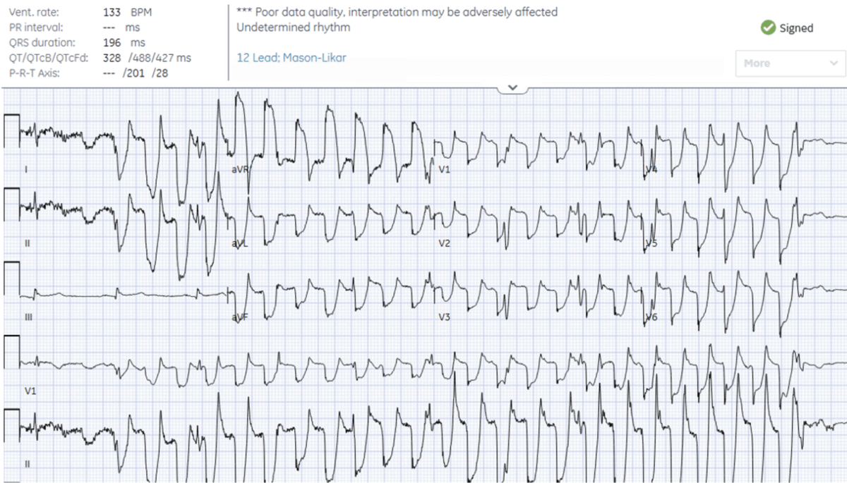 Unstable tachycardia, cardiovert? | ECG Cases | Emergency Medicine Cases