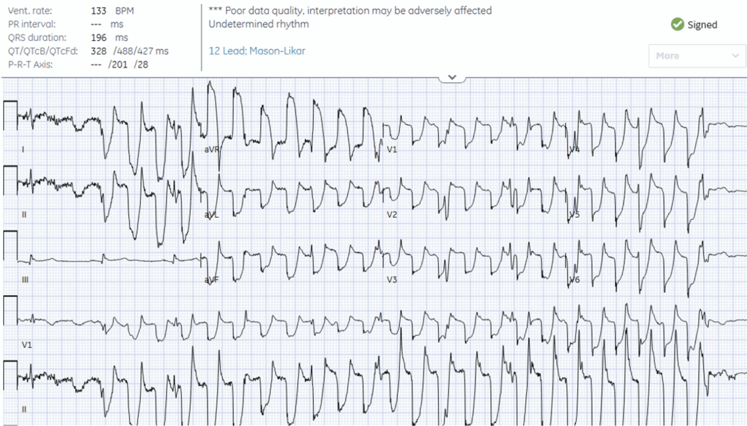 Unstable tachycardia, cardiovert? | ECG Cases | Emergency Medicine Cases