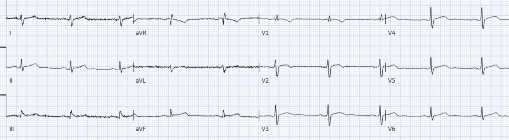 Unstable tachycardia, cardiovert? | ECG Cases | Emergency Medicine Cases