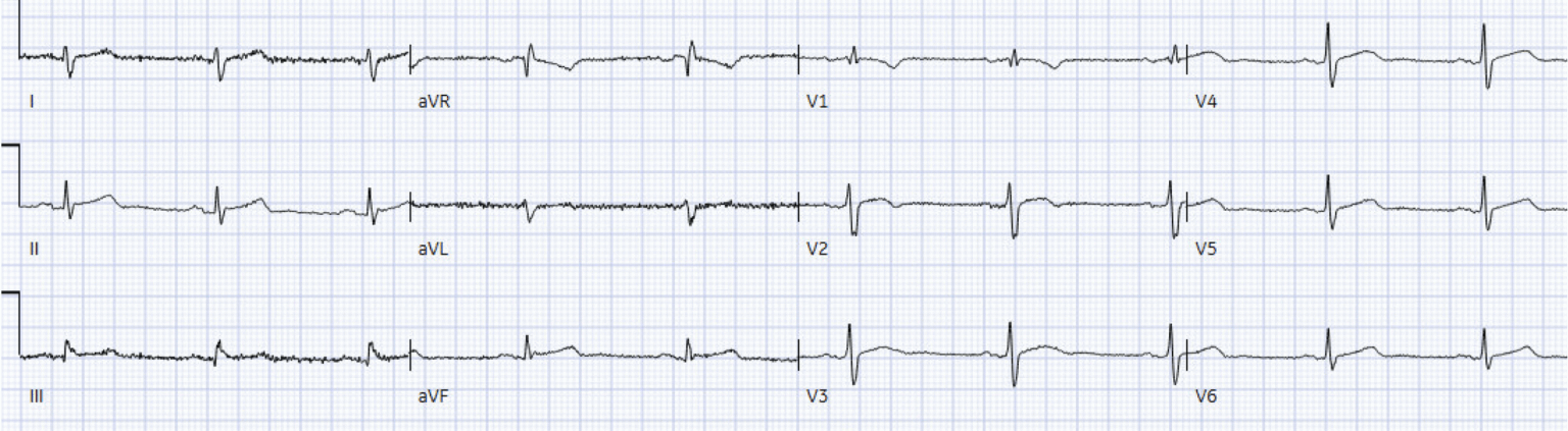 Unstable tachycardia, cardiovert? | ECG Cases | Emergency Medicine Cases